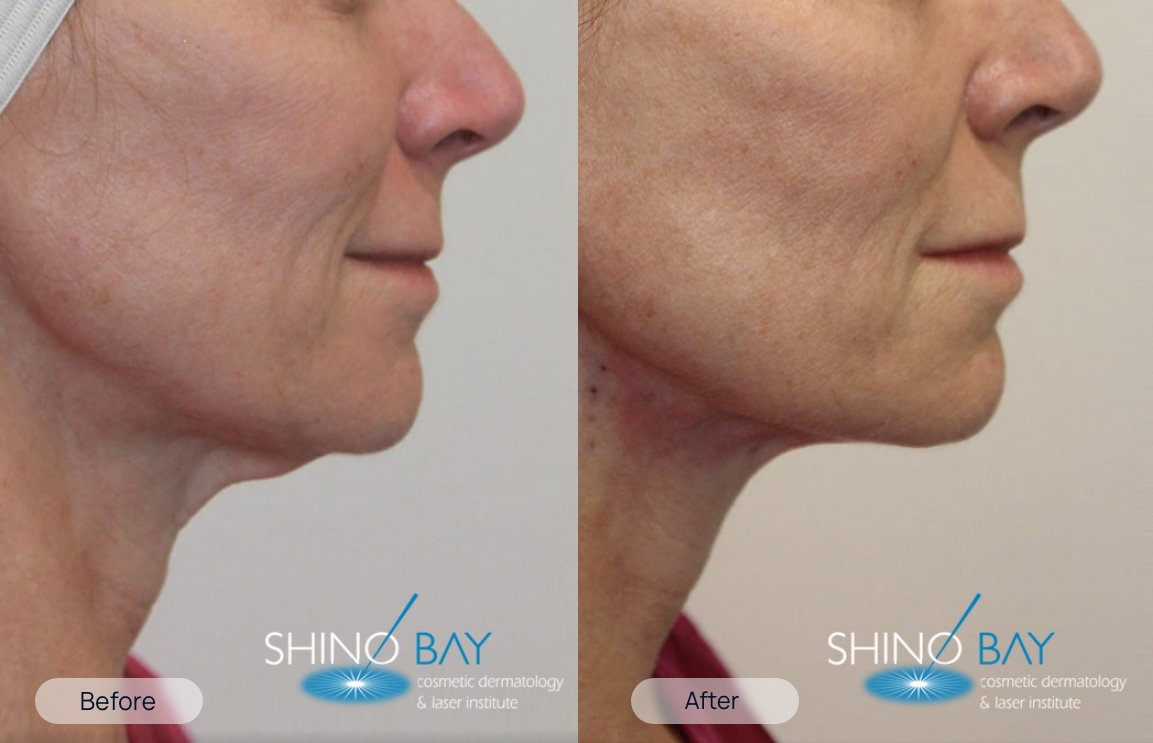 Skin Tightening & Lifting Fort Lauderdale - Reduce Sagging